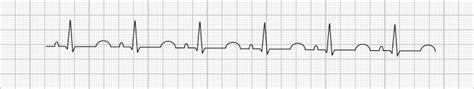 Long Qt Syndromes And Torsades De Pointes Clinical Tree