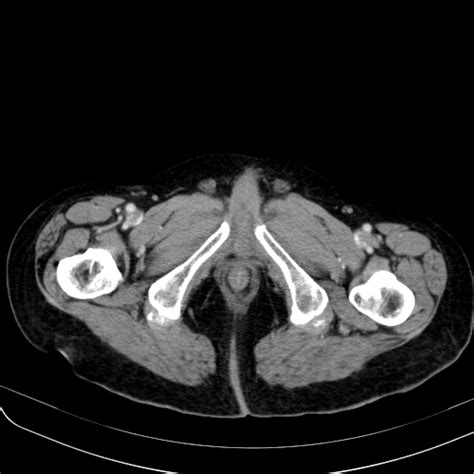 File Small Bowel Volvulus Causing Small Bowel Obstruction Mimicking Intussusception