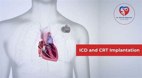 Icd And Crt Implantation Dr Shirish Agarwal Top Cardiologist
