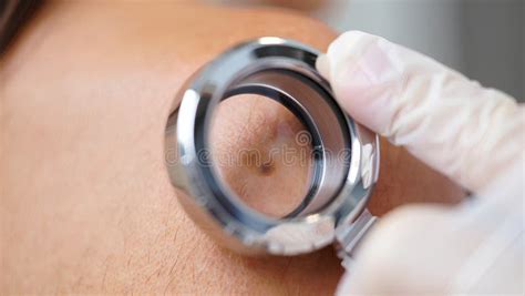 Suspicious Skin Mole Stock Illustrations 60 Suspicious Skin Mole