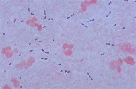 Gram Positive Diplococci Lancet Shaped Evaluating Sputum And Pleural