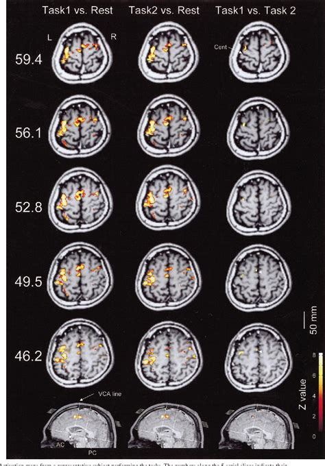 Pdf Activation Of The Dorsal Premotor Cortex And Pre Supplementary