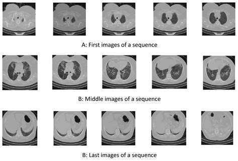 A Deep Learning Algorithm To Detect Coronavirus COVID Disease Using CT Images PeerJ