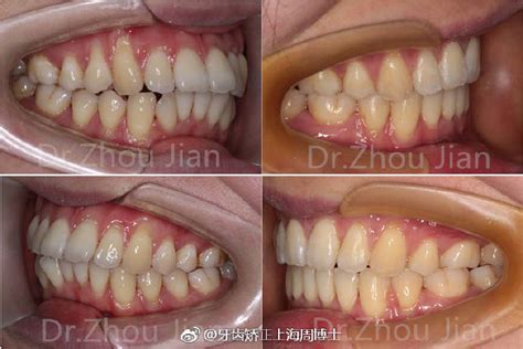 正常的牙龈和萎缩对比 轻度 大山谷图库