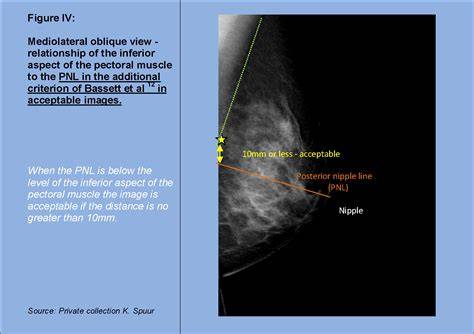 Mammography Image Quality Model For Predicting Compliance With