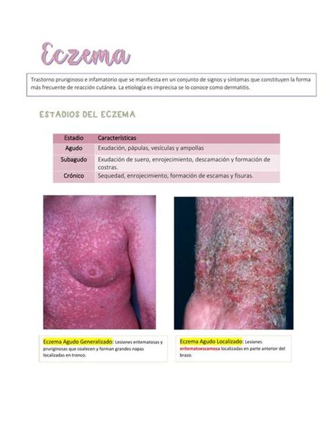 Eczema Y Psoriasis Valeria Rosero Udocz
