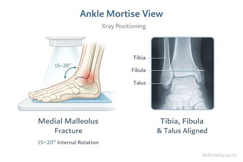Lateral Malleolus Fracture Symptoms Treatment Surgery And Recovery Time