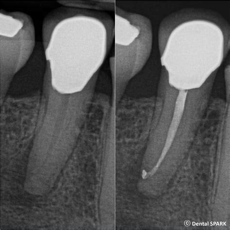 Dental Spark This Patient Developed Acute Apical Abscess Facebook