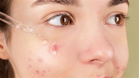 How To Get Rid Of Pimple Marks Follow These 4 Effective Methods
