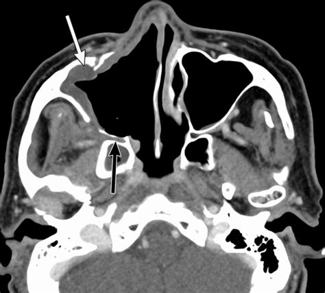 Posttreatment Head And Neck Cancer Imaging Anatomic Considerations