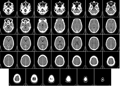 Stroke Survivors Tattler X Ray Computed Tomography CT Scan