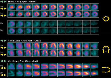 35 Diaphragmatic Attenuation Artifact Radiology Key