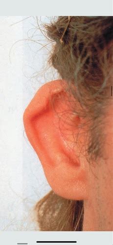 Outer Ear Disorders Study Terms And Definitions For Medicine Flashcards