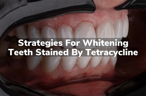 Strategies For Whitening Teeth Stained By Tetracycline