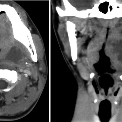 Contrast‐enhanced Computed Tomography Ct Of The Lateral Side Of The Download Scientific