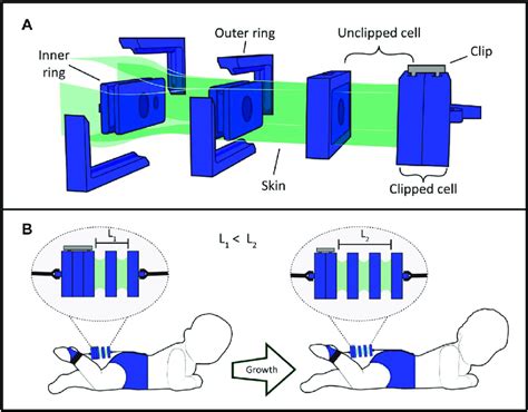 Working Principle For The BVA Presented In This Work Including A Download Scientific Diagram