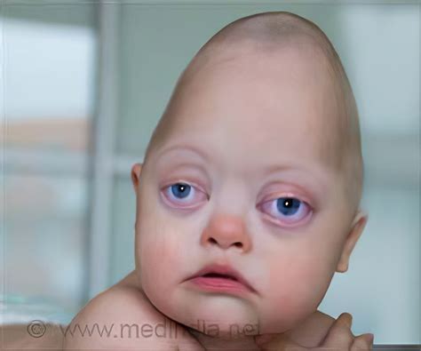 Pfeiffer Syndrome Treatment