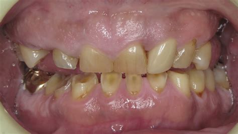 Designing A Smile For A Case Of Severe Attrition Oasis Discussions