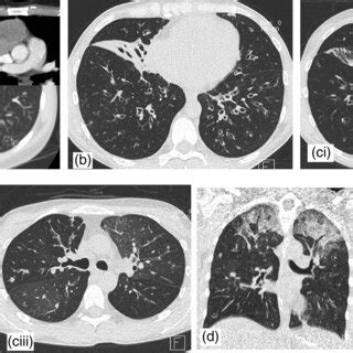 A Baseline Computed Tomography CT Scan Diffuse Treeinbud Download Scientific Diagram