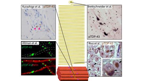 Tdp 43 Axonal Pathology An Illustrative Map Of A Motor Neuron With