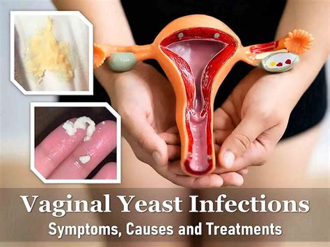 Vaginal Yeast Infections Symptoms Causes And Treatment Doctor Zara