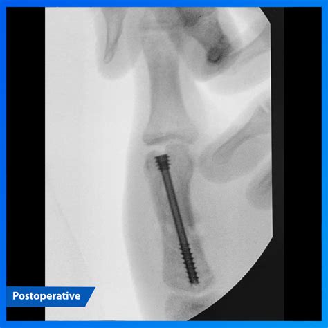 Fractura Del Primer Metacarpiano Tratada Con Brm Tool Screws Medcomtech