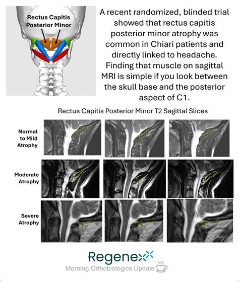 Rectus Capitis Posterior Minor Atrophy Is Probably Worth Looking For In
