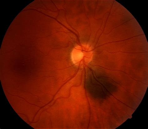 Retinal Nevus Icd 9 Code