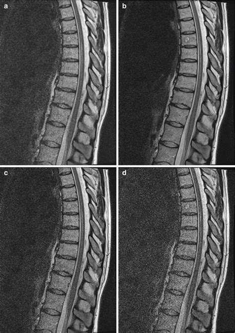 Magnetic Resonance Imaging Mri Methods Neupsy Key