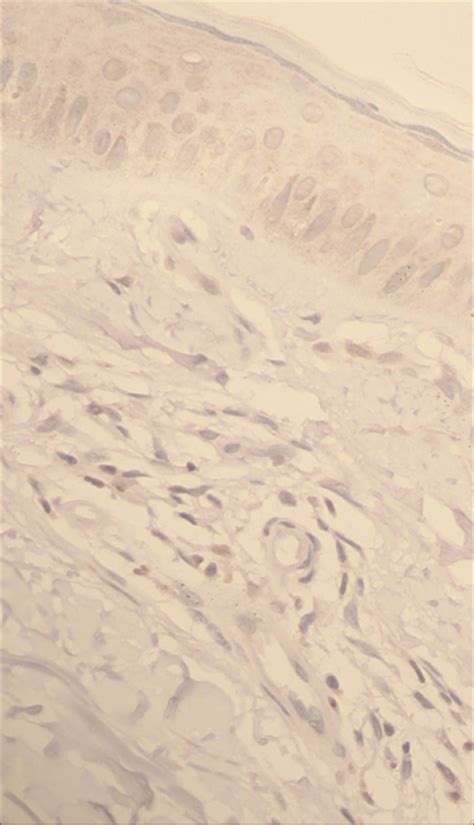 Thymocyte Selection Associated High Mobility Group Box As A Potential Diagnostic Marker