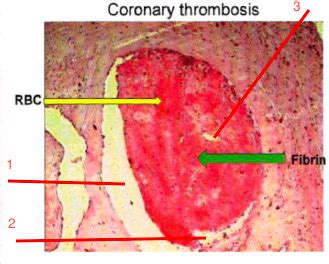 Fibrin Thrombus Histology