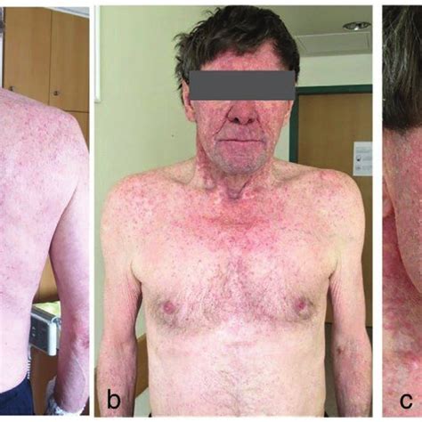 Follicular Papulopustular Eruption With Emphasis On Seborrheic And