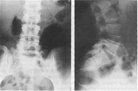 Radiographs Of Case B The Ap And Lateral Views Show A Lumbosacral Download Scientific Diagram