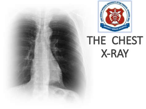 Chest Xray Radiograph Brief Explain Pptx