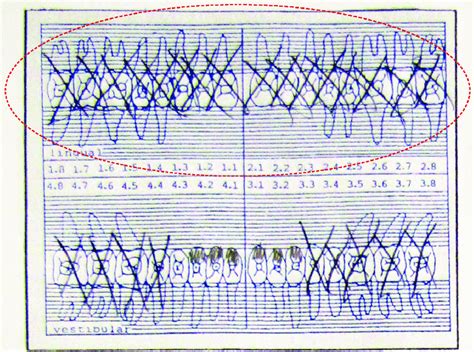 Odontogram Of The Suspect Completely Edentulous Maxilla In Initial
