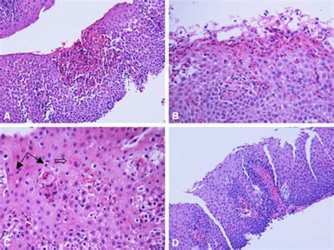 L5 Esophageal Disorders Flashcards Quizlet