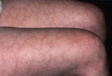 Livedo Reticularis My Gp Notes