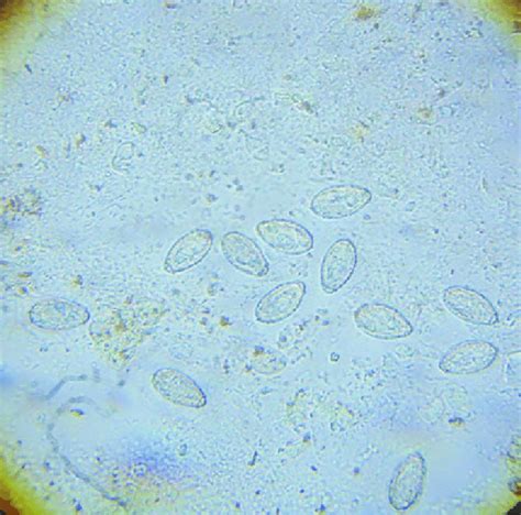 Microphotograph Of Eggs Of Opisthorchis Tenuicollis 100x Download