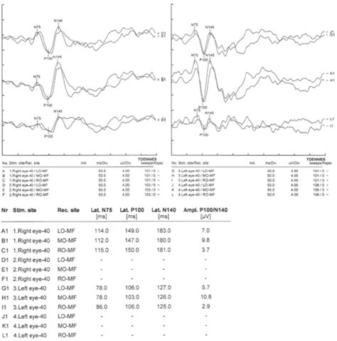 Pattern Reversal Visual Evoked Potentials Test Shows Prolonged P100 Download Scientific Diagram