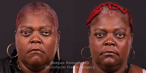 Orbital Decompression Center For Eye And Facial Plastic Surgery