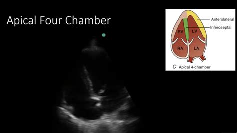 Remember The Great Examples Of The Various Wall Motion Abnormalities Begin At 600 And Should