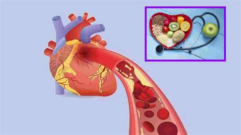 High Triglyceride Levels ట్రై గ్లిసరైడ్స్ లెవల్స్ పెరిగితే గుండె పోటు ముప్పు పొంచిఉన్నట్లేనా