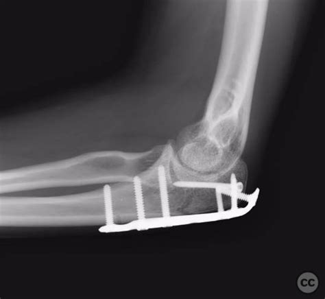 Olecranon Osteosynthesis With Locked Plate In Comminuted Fracture