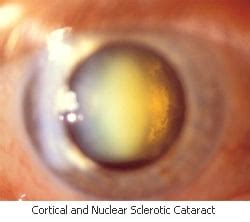 Nuclear Sclerosis Of The Eye
