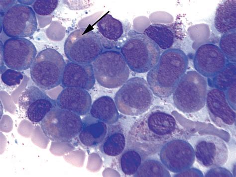 Ost 578 9 Myeloid Neoplasia Flashcards Quizlet
