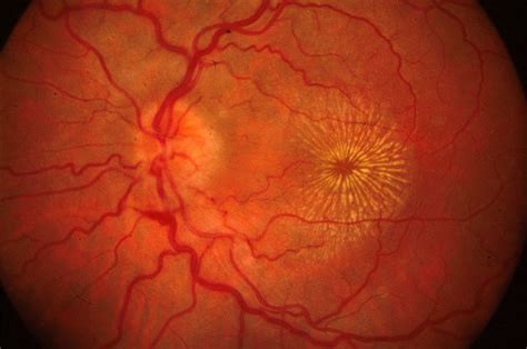 Hypertension And Hypertensive Retinopathy Flashcards Quizlet