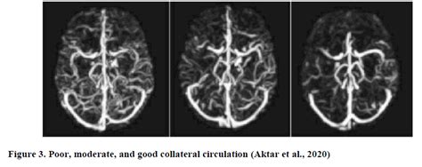 Collateral Circulation Characteristic Based On Cone Beam Computed Tomography Cbct Images In