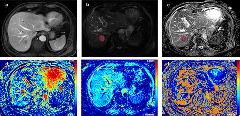 Intravoxel Incoherent Motion Improves The Accuracy Of Preoperative Pre Jhc