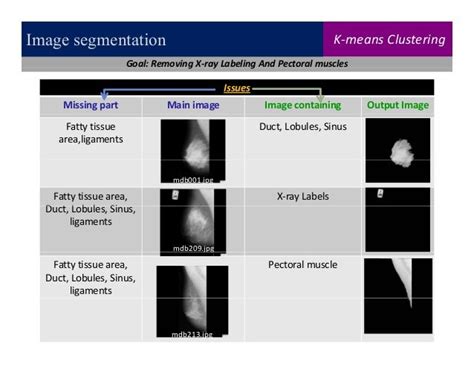 Microcalcification Identification In Digital Mammogram For Early Dete…