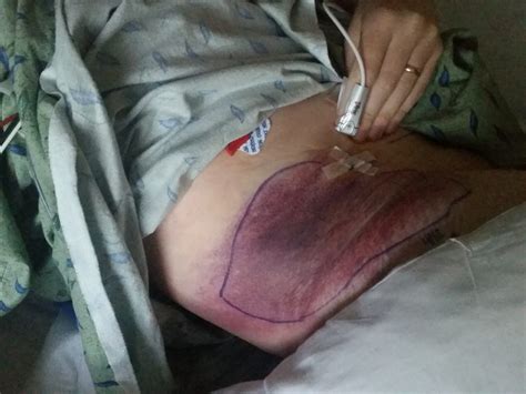 Internal Abdominal Bleeding